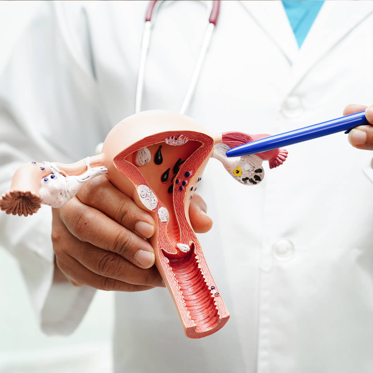 Cervical Cancer and Its Treatment Options - SYNLAB Nigeria